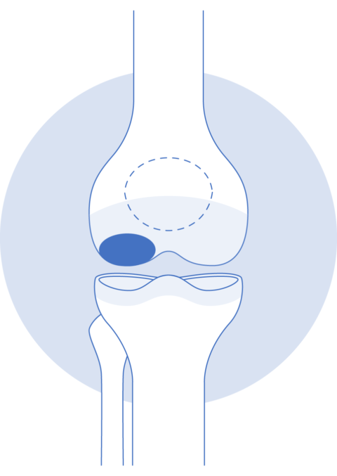 Knee Cartilage Regeneration | Sven Knee Surgeon