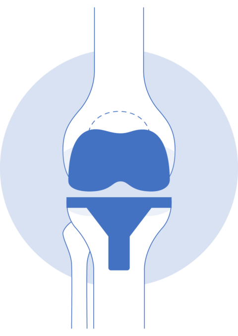 Total Knee Replacement Surgery | Sven Knee Surgeon